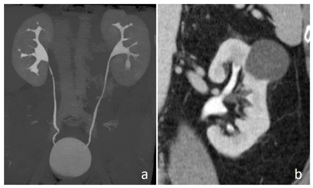 CT Urography / Dual / Triple phase Organ Imaging - Noble Imaging And ...