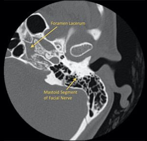 HRCT Chest / Temporal Bone (Cochlear Imaging )/PNS - Noble Imaging And ...